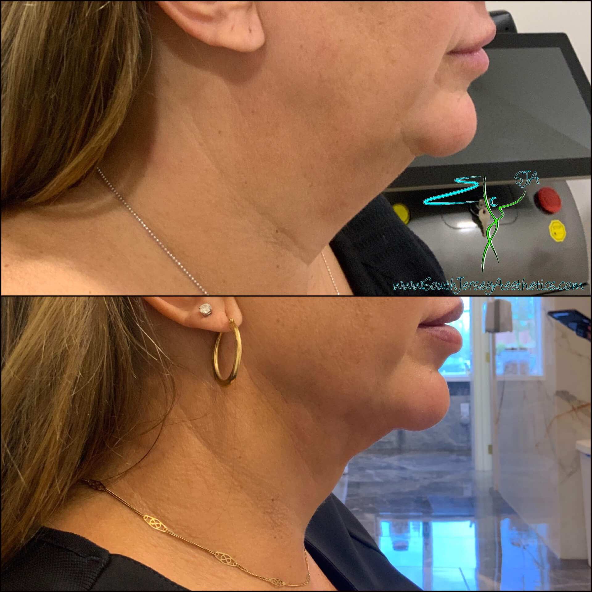 Ultra Neck Lift - South Jersey Aesthetics