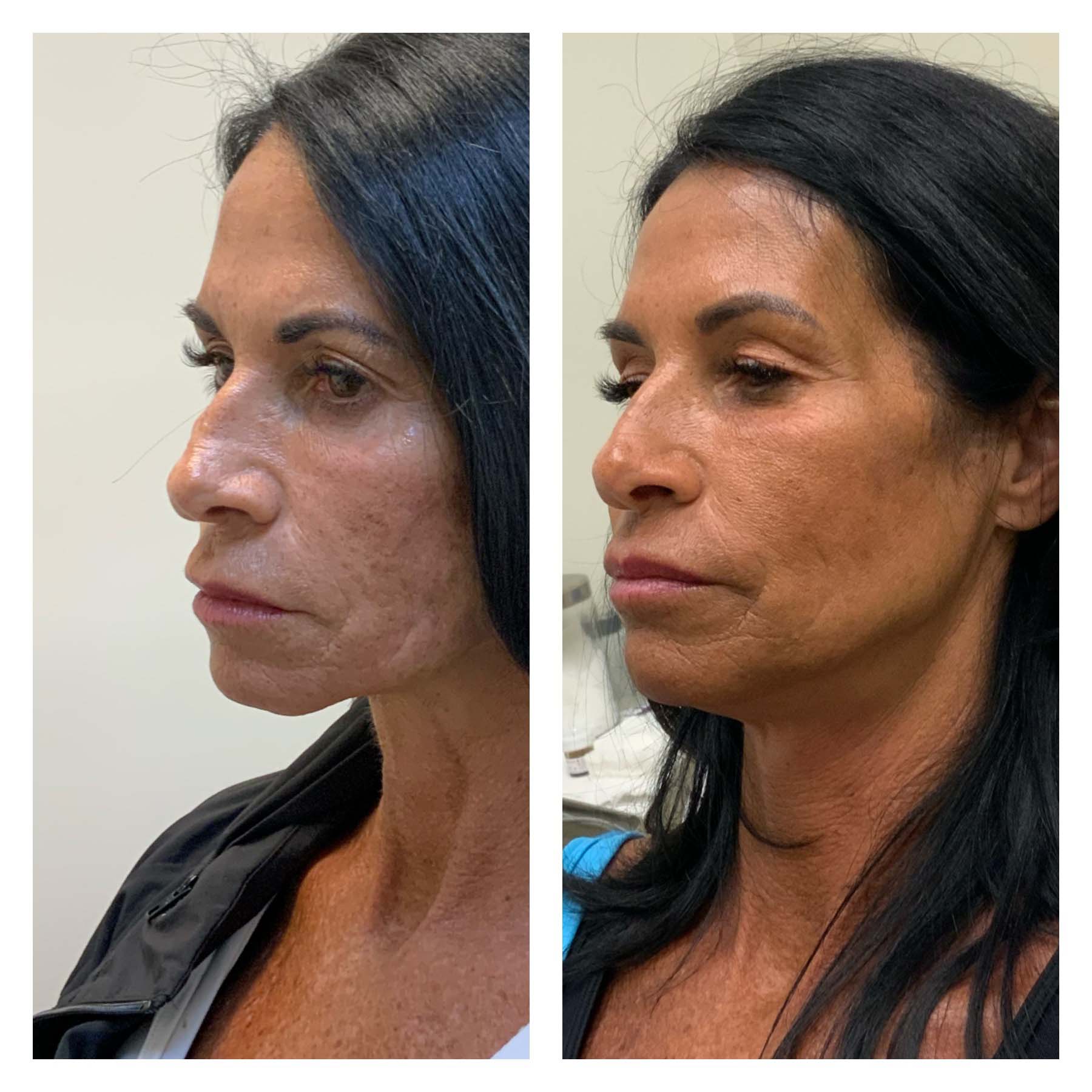 PDO Thread lifts - South Jersey Aesthetics